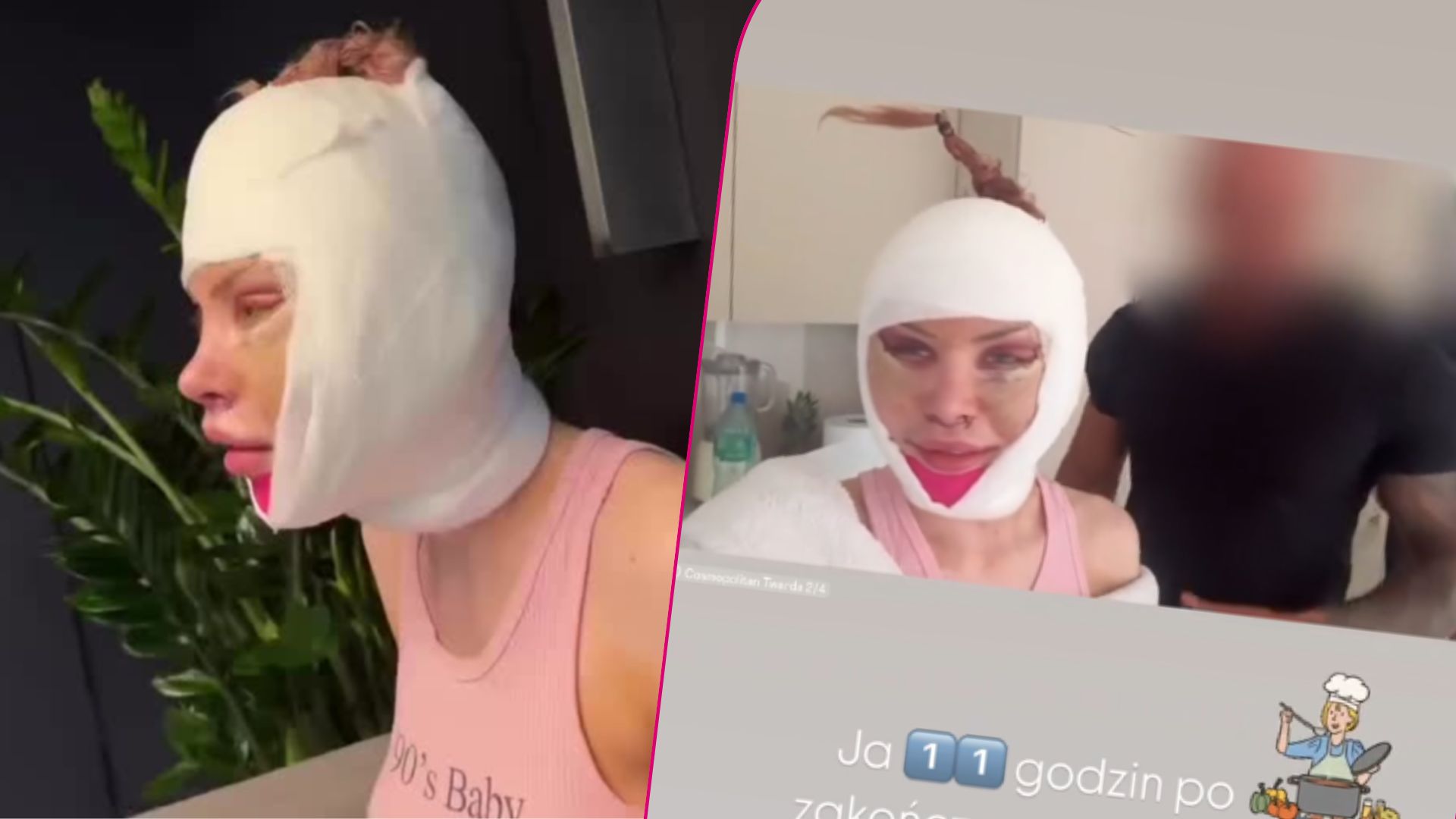 Julia von Stein zrobiła lifting. Fani się martwią: "To się źle skończy"