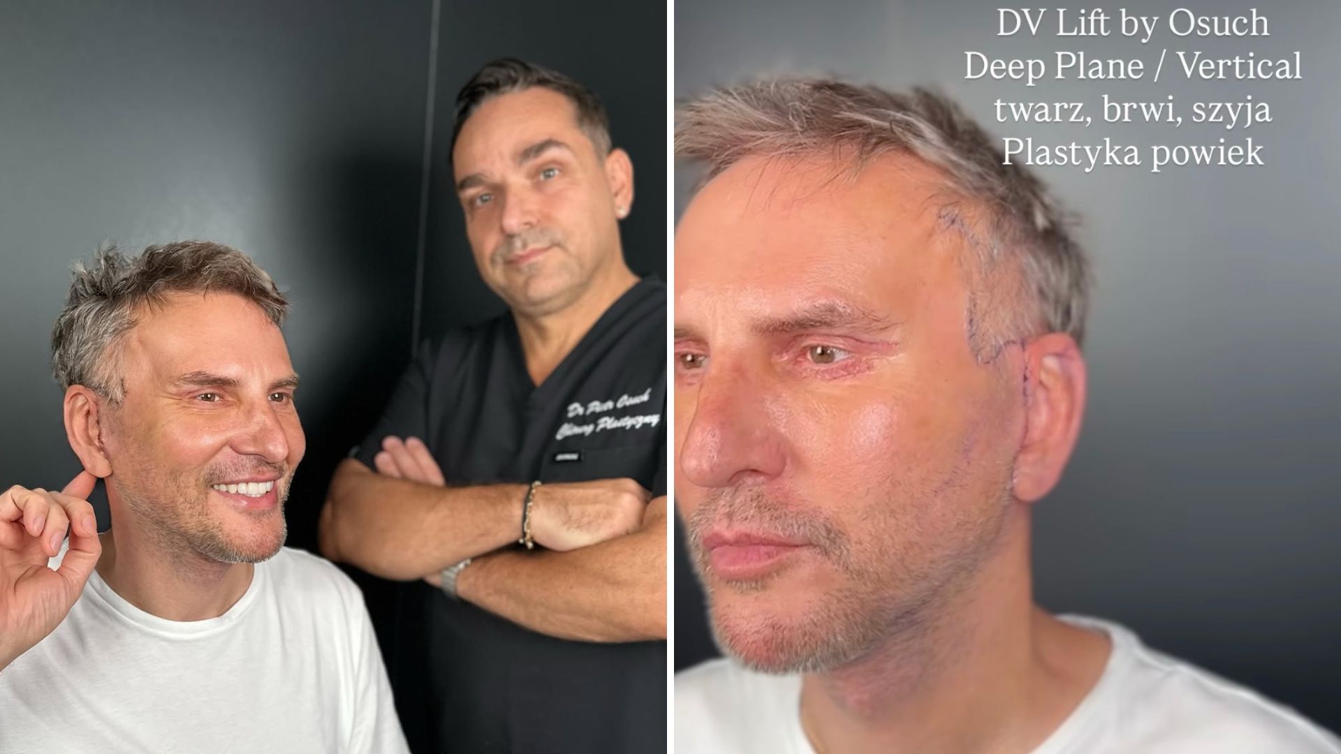 Krzysztof Gojdź zrobił sobie lifting twarzy. Tak wygląda po tygodniu!